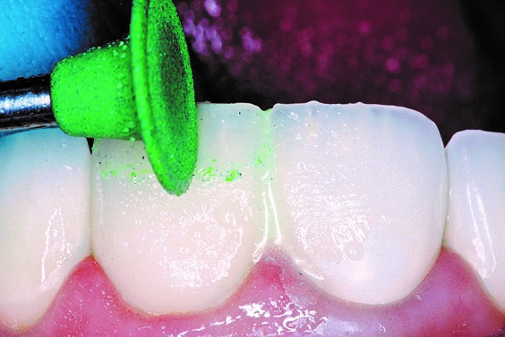 How To Repair Porcelain Restorations Instead Of Replacing Them