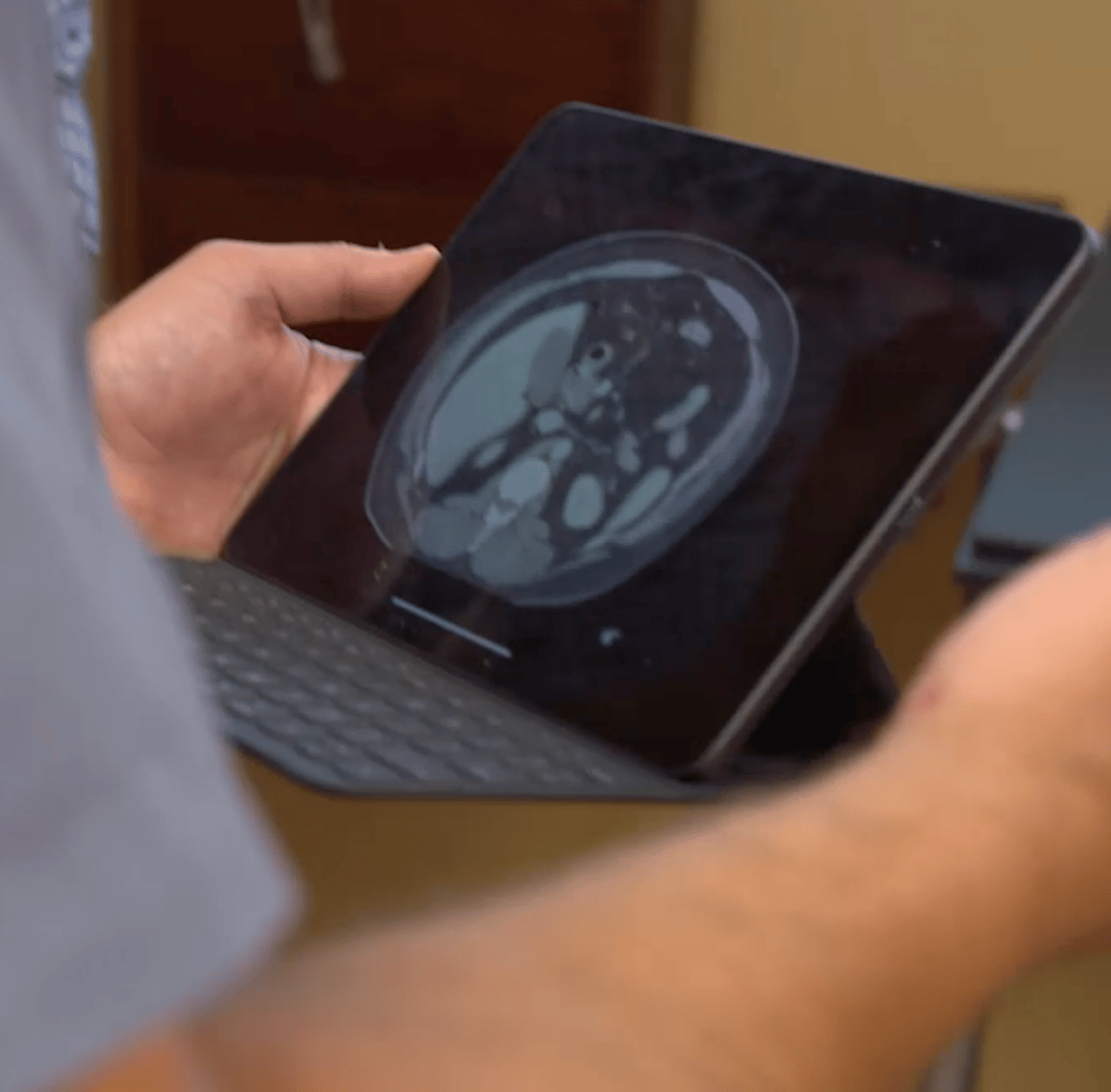 Hernia Facts | about HERNIA