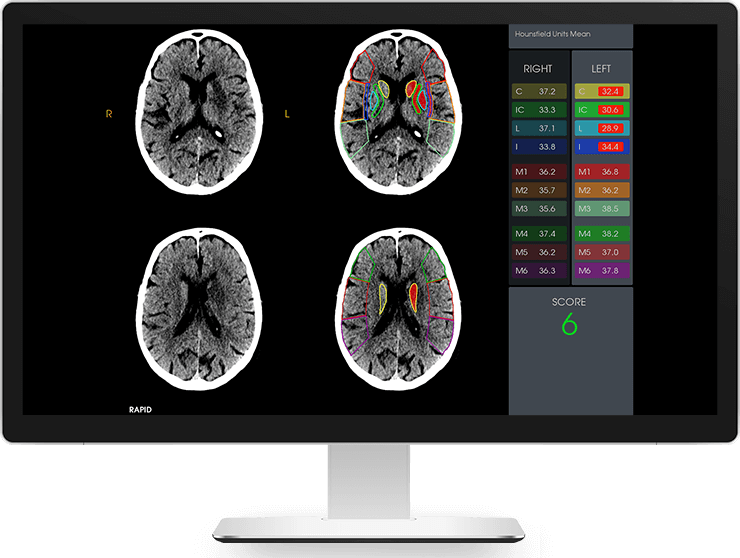 Neuroimaging Stroke Software Platform Powered by AI | RapidAI